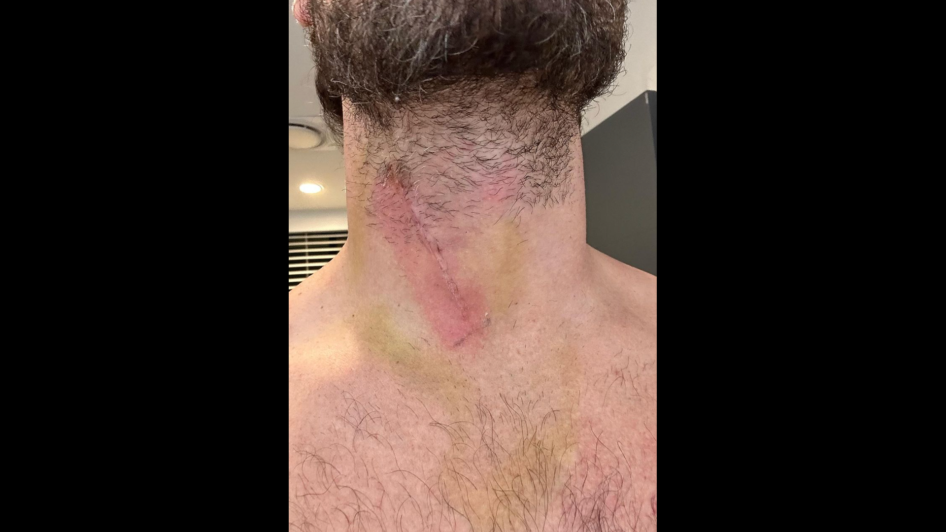 Val Chmerkovskiy Shares Pics From Hospital Bed After Painful Neck ...