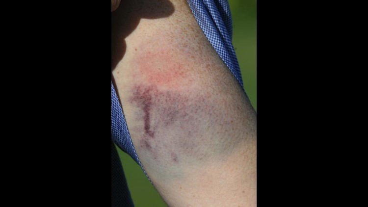 Bruise-detecting camera aims to stop domestic violence | whas11.com