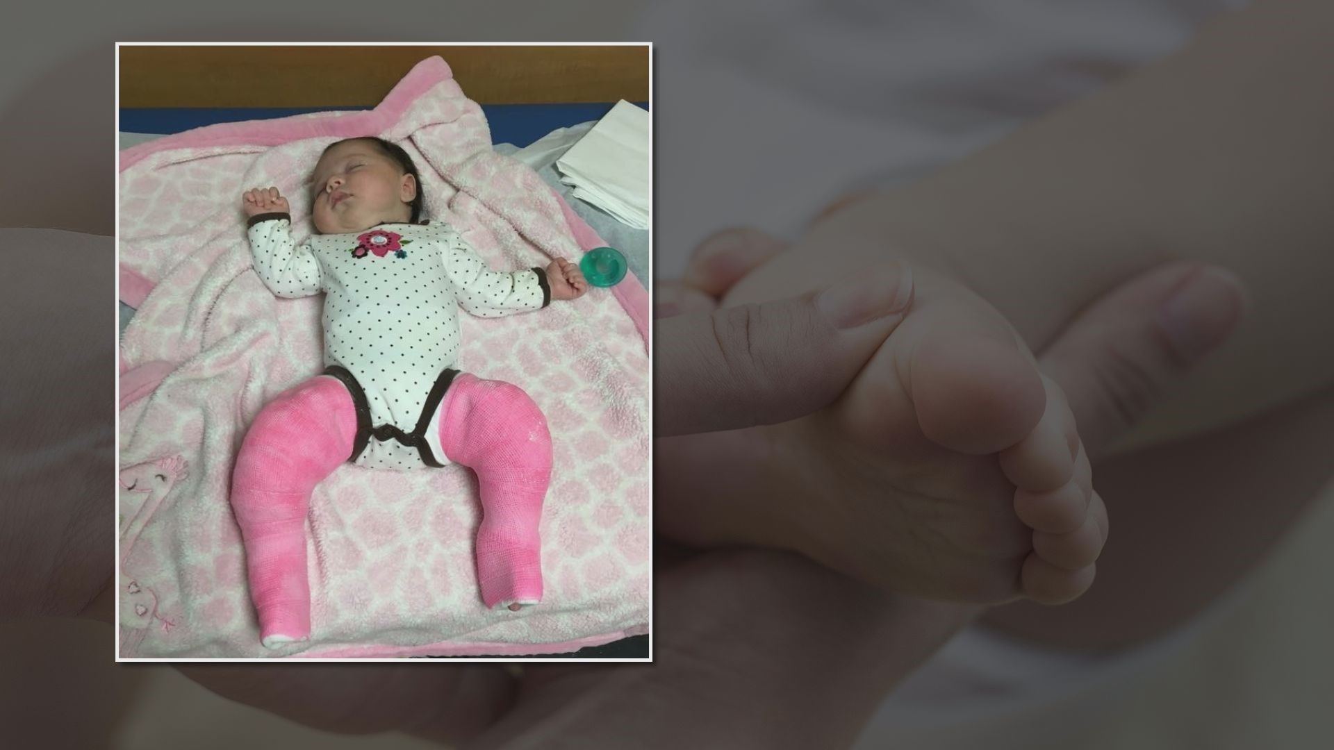 Kentucky family describes Clubfoot treatment process | whas11.com