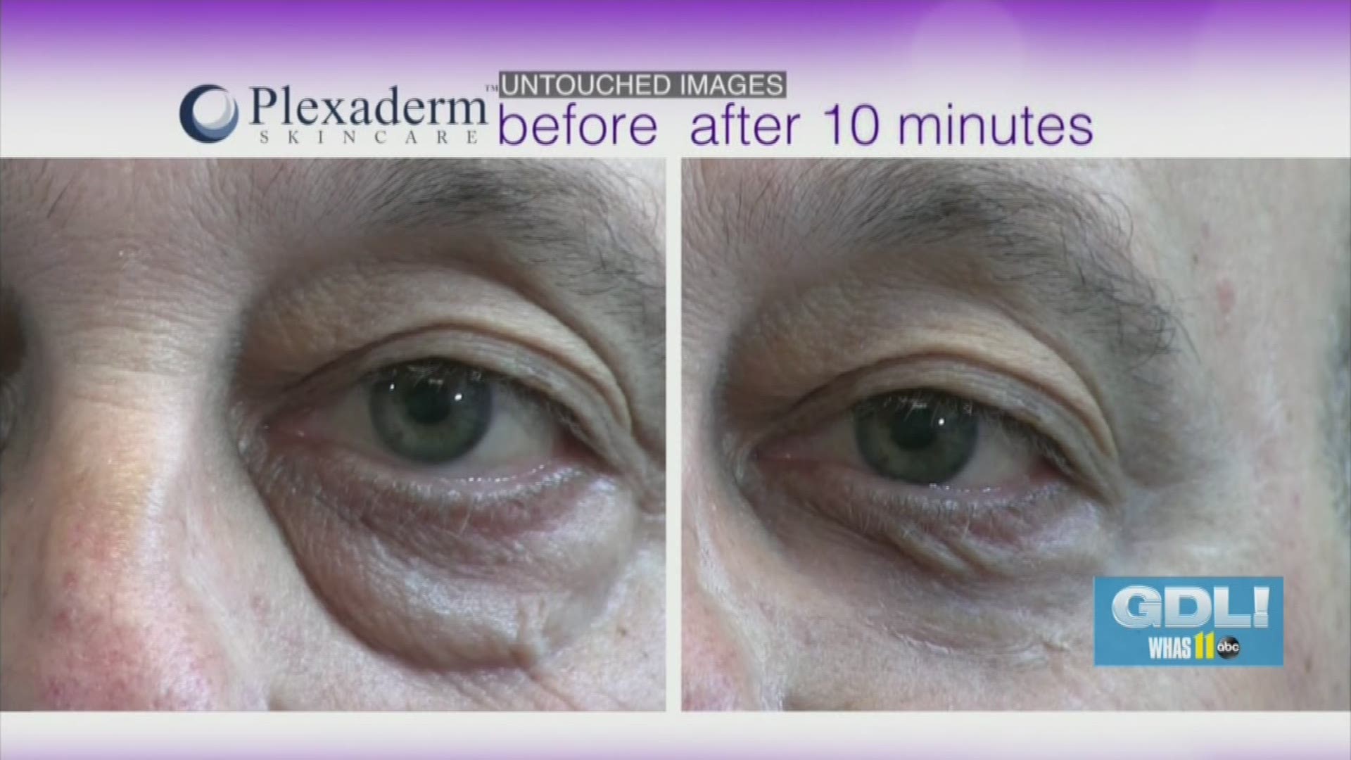 Plexaderm rejuvenates wrinkled skin | whas11.com