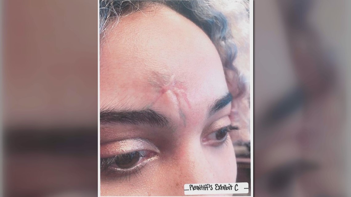 Rubber bullet fired by LMPD hits protester in face, lawsuit says ...