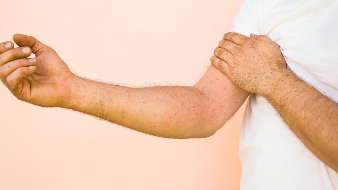 Measles | Where to find your immunization records in Kentucky | whas11.com