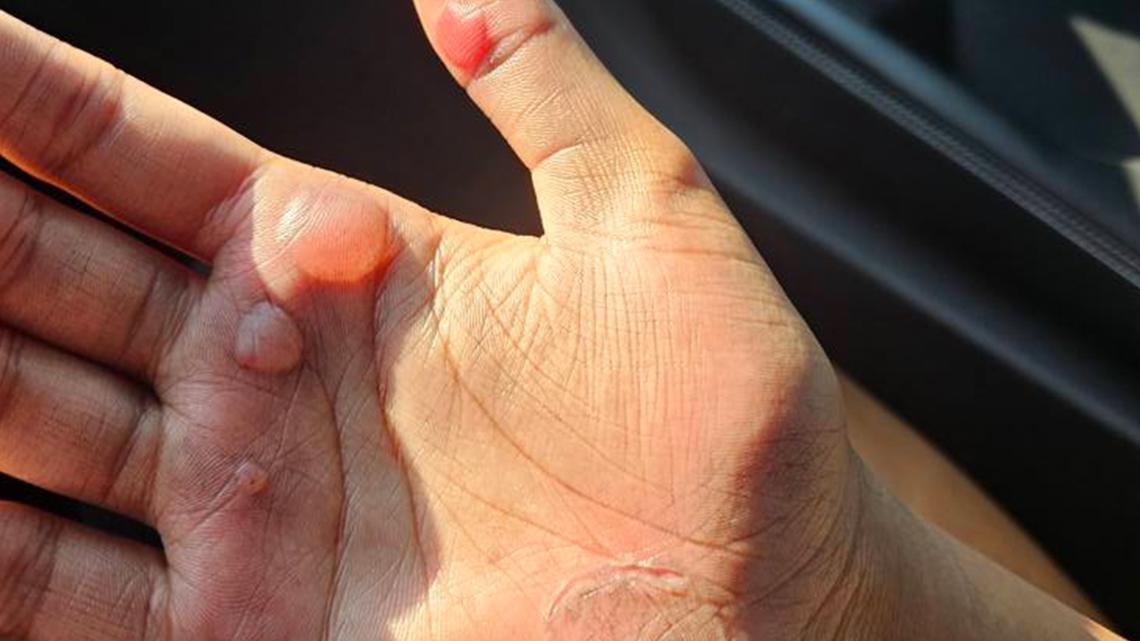 Warren Central student gets second-degree burns from punishment ...