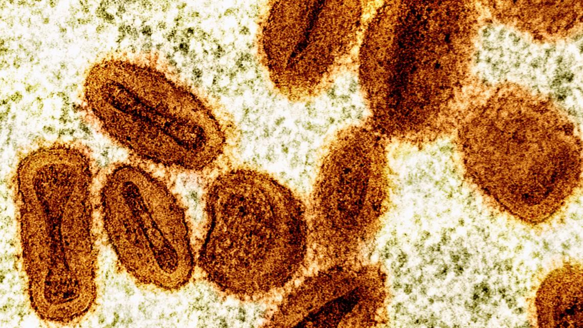 US health officials report 1st case of new form of mpox | whas11.com